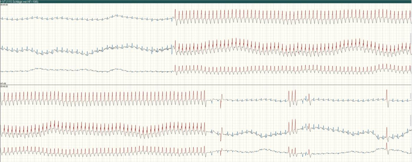 Sustained Ventricular Tachycardia Ecg Guru Instructor Resources 7560